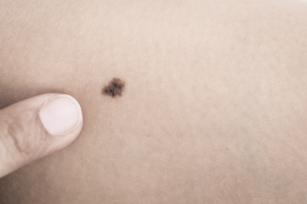 Ακανθοκυτταρικό Καρκίνωμα | Derma Lounge Clinic - Δερματολογική Κλινική